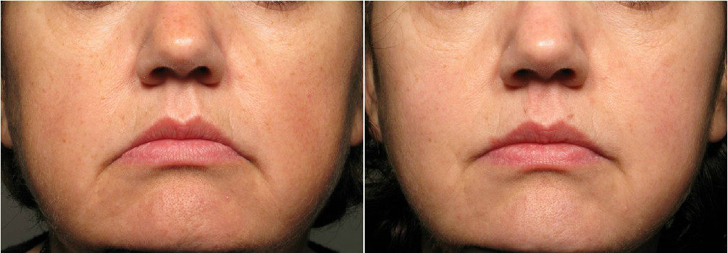 Ulthera Facelift and Neck Lift San Ramon | California Dermatology