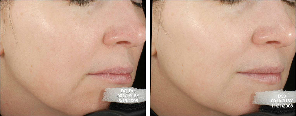 Ulthera Facelift and Neck Lift San Ramon | California Dermatology
