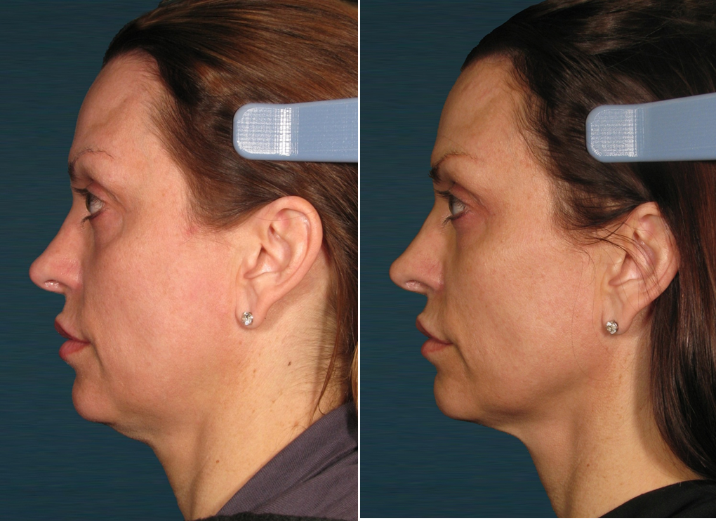 Ulthera Facelift and Neck Lift San Ramon | California Dermatology