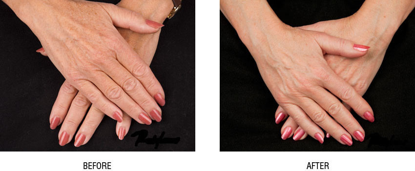 Dermal Fillers Before & After Photos | San Ramon | Dr. William Ting