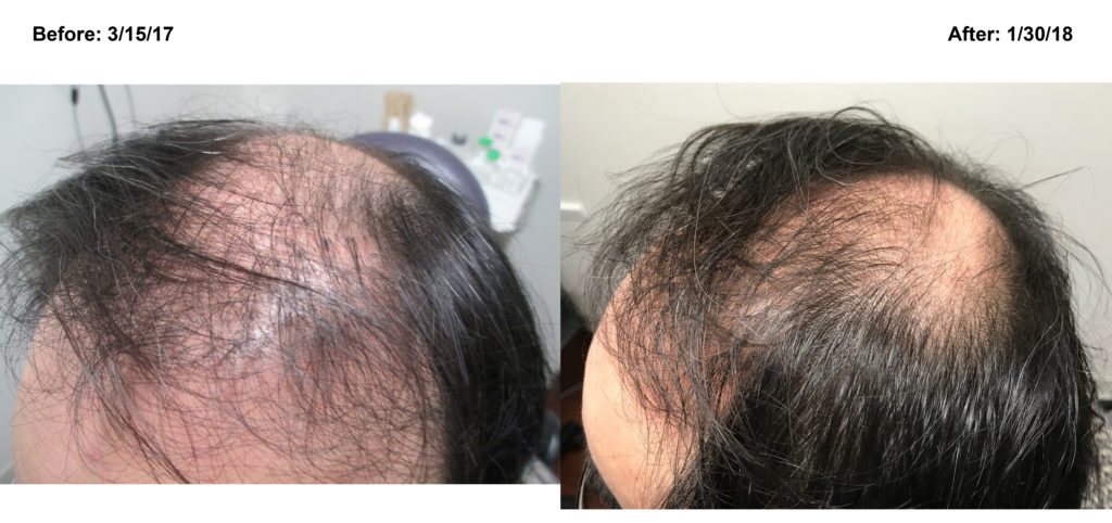Hair Restoration Before & After Photos | San Ramon | Dr. William Ting
