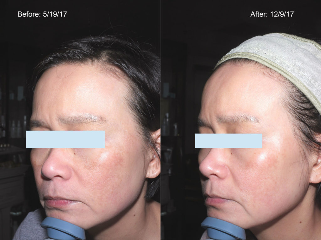 Microneedling Before & After Photos | San Ramon | Dr. William Ting