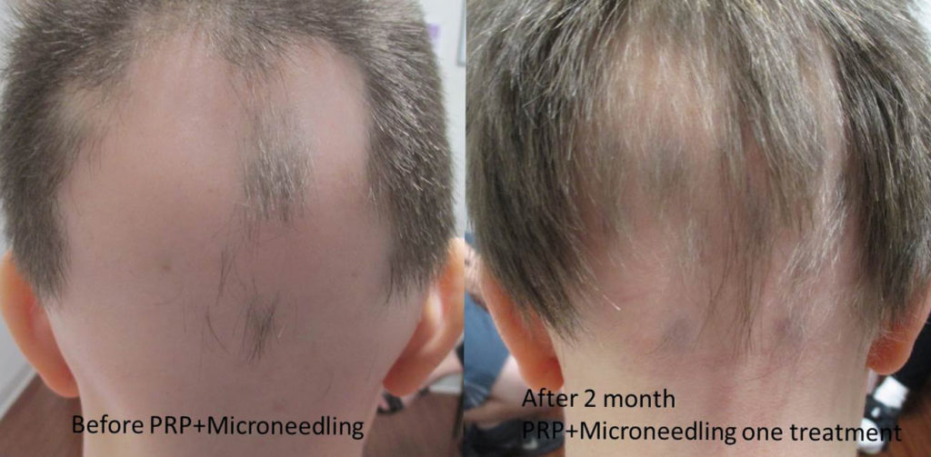 Hair Restoration Before & After Photos | San Ramon | Dr. William Ting