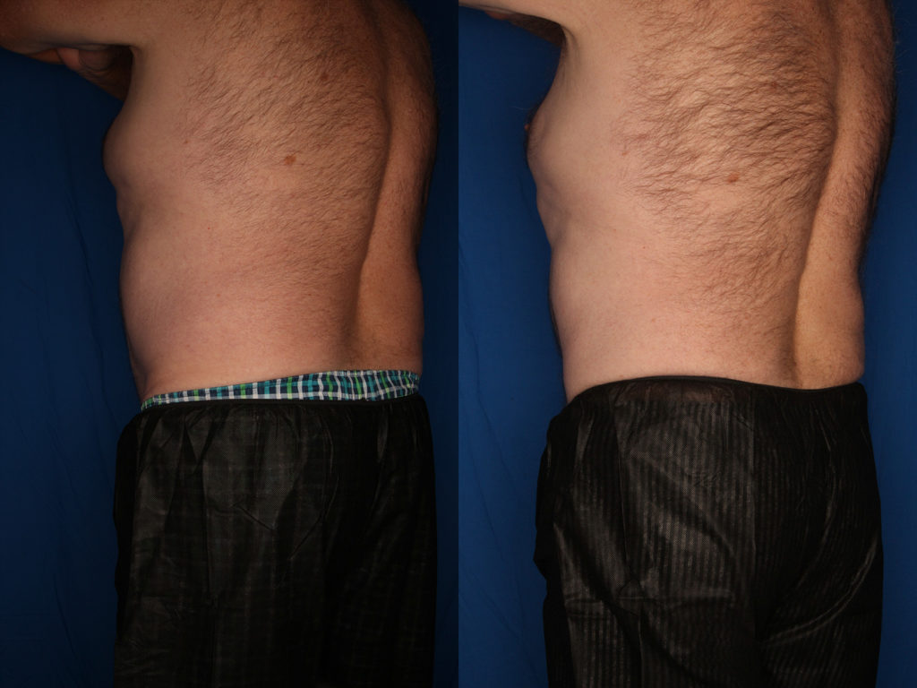 CoolSculpting Before & After Photos | San Ramon | Dr. William Ting