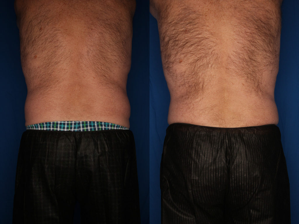 CoolSculpting Before & After Photos | San Ramon | Dr. William Ting