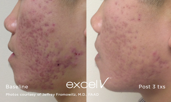 Excel V Before & After Photos | San Ramon | Dr. William Ting